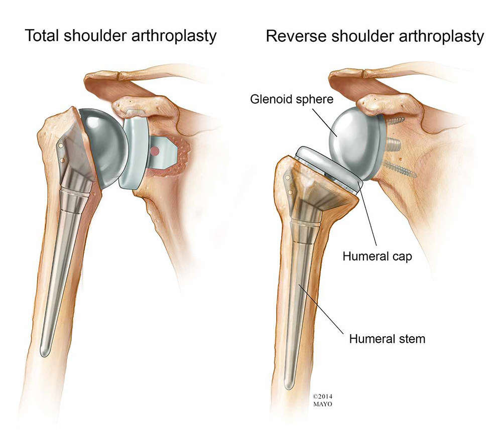 Standard Anatomic Total Shoulder Replacement Dr Gordon Groh