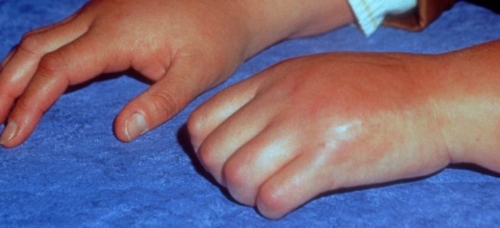 Complex Regional Pain Syndrome - Dr. Groh