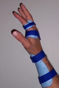Extensor Tendon Injuries - Dr. Groh